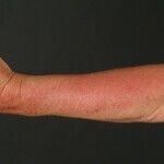 Phototoxic dermatitis - Altmeyers Encyclopedia - Department Dermatology