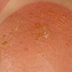 Dermatitis solaris - Altmeyers Enzyklopädie - Fachbereich Dermatologie
