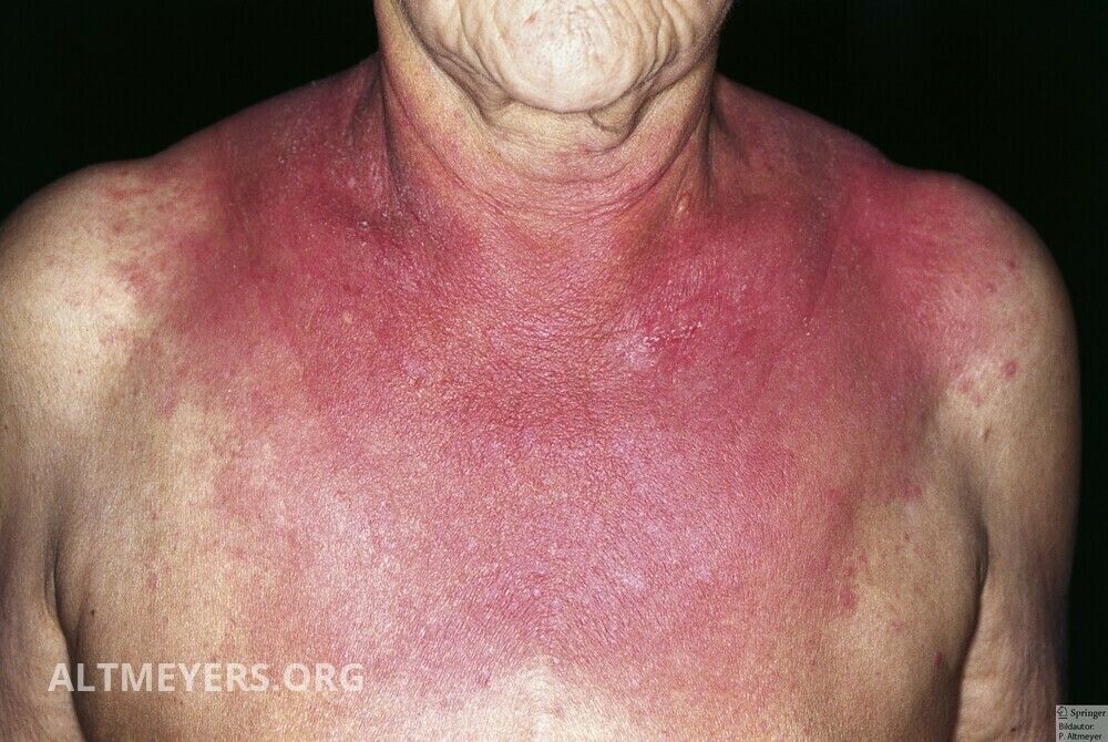 V Sign Dermatomyositis