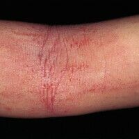 Atopische Dermatitis (Übersicht) Bilder - Altmeyers Enzyklopädie ...