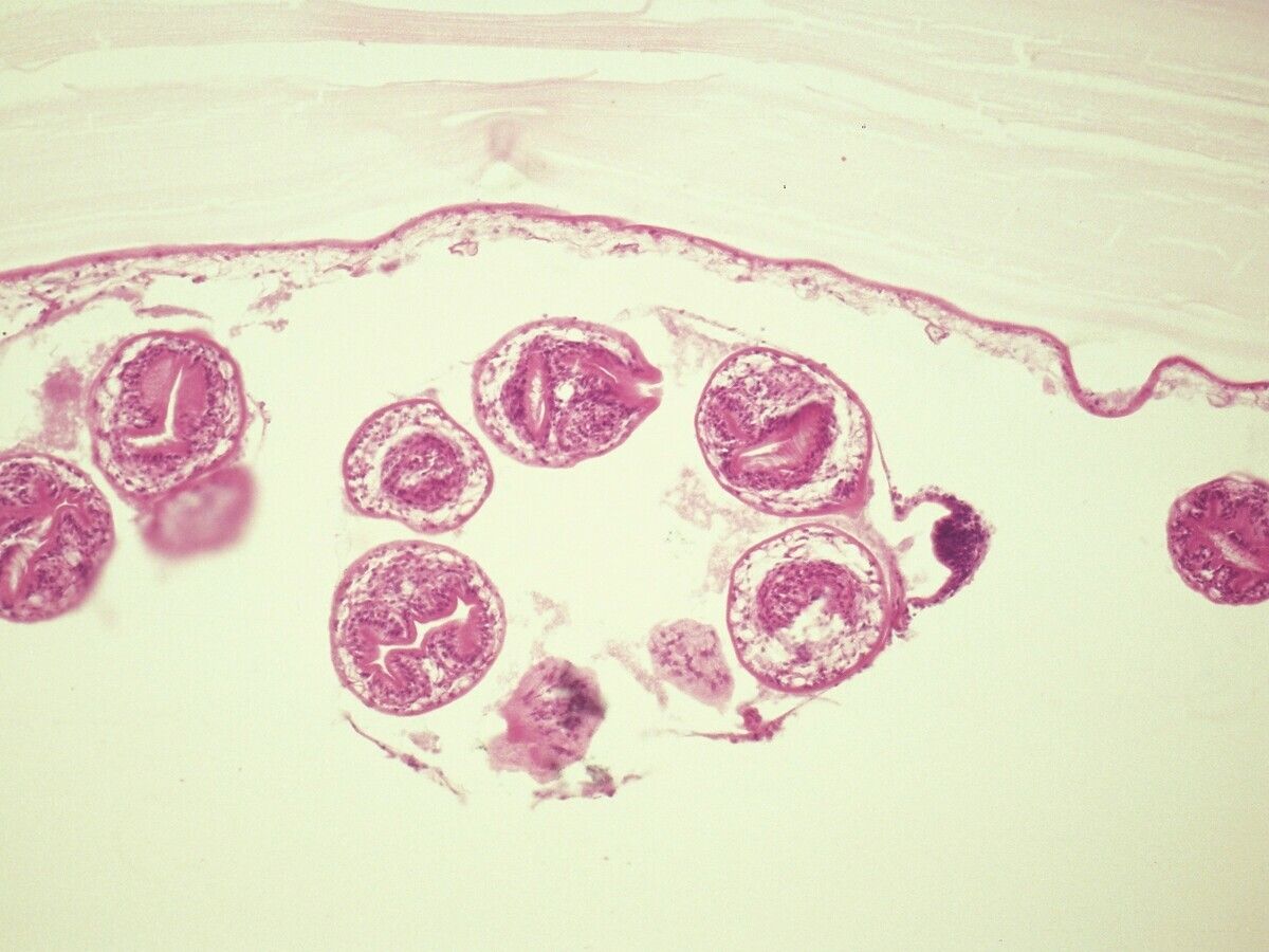 Echinococcus Multilocularis Cyst