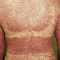 Photoallergische Dermatitis Images - Altmeyers Encyclopedia ...