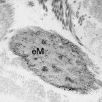 Actinic elastosis - Altmeyers Encyclopedia - Department Dermatology