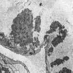 Actinic elastosis - Altmeyers Encyclopedia - Department Dermatology