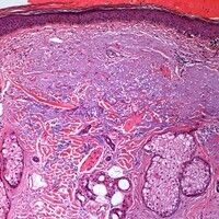 Aktinische Elastose Bilder - Altmeyers Enzyklopädie - Fachbereich ...