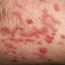 Stria migrans - Altmeyers Encyclopedia - Department Dermatology