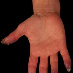 Thrombangiitis obliterans - Altmeyers Enzyklopädie - Fachbereich ...