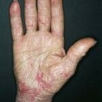 Hand and foot eczema, hyperkeratotic-rhagadiformes - Altmeyers ...