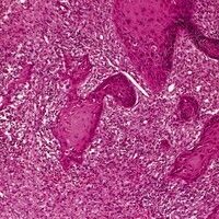 Epidermalzyste, proliferierende Images - Altmeyers Encyclopedia ...