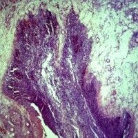 Amebiasis Images - Altmeyers Encyclopedia - Department Internal medicine