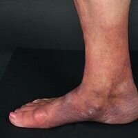 Acrodermatitis chronica atrophicans Images - Altmeyers Encyclopedia ...