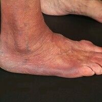 Acrodermatitis chronica atrophicans Images - Altmeyers Encyclopedia ...