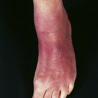 Acrodermatitis chronica atrophicans Images - Altmeyers Encyclopedia ...