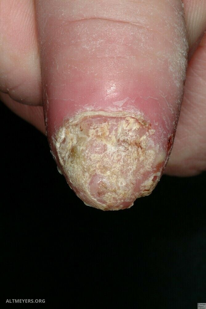 Acrodermatitis Continua Of Hallopeau