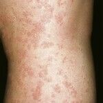 Gianotti-Crosti-Syndrom - Altmeyers Enzyklopädie - Fachbereich Dermatologie