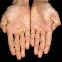 Morbus Addison Images - Altmeyers Encyclopedia - Department Internal ...