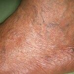 Acrodermatitis chronica atrophicans - Altmeyers Encyclopedia ...