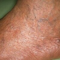 Acrodermatitis chronica atrophicans Images - Altmeyers Encyclopedia ...