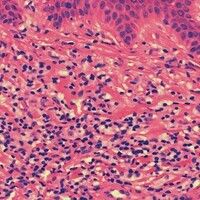 Acrodermatitis chronica atrophicans Bilder - Altmeyers Enzyklopädie ...