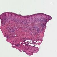 Acrodermatitis chronica atrophicans Images - Altmeyers Encyclopedia ...