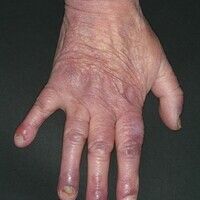Acrodermatitis chronica atrophicans Images - Altmeyers Encyclopedia ...