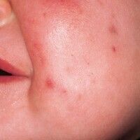 Acne infantum Bilder - Altmeyers Enzyklopädie - Fachbereich Dermatologie