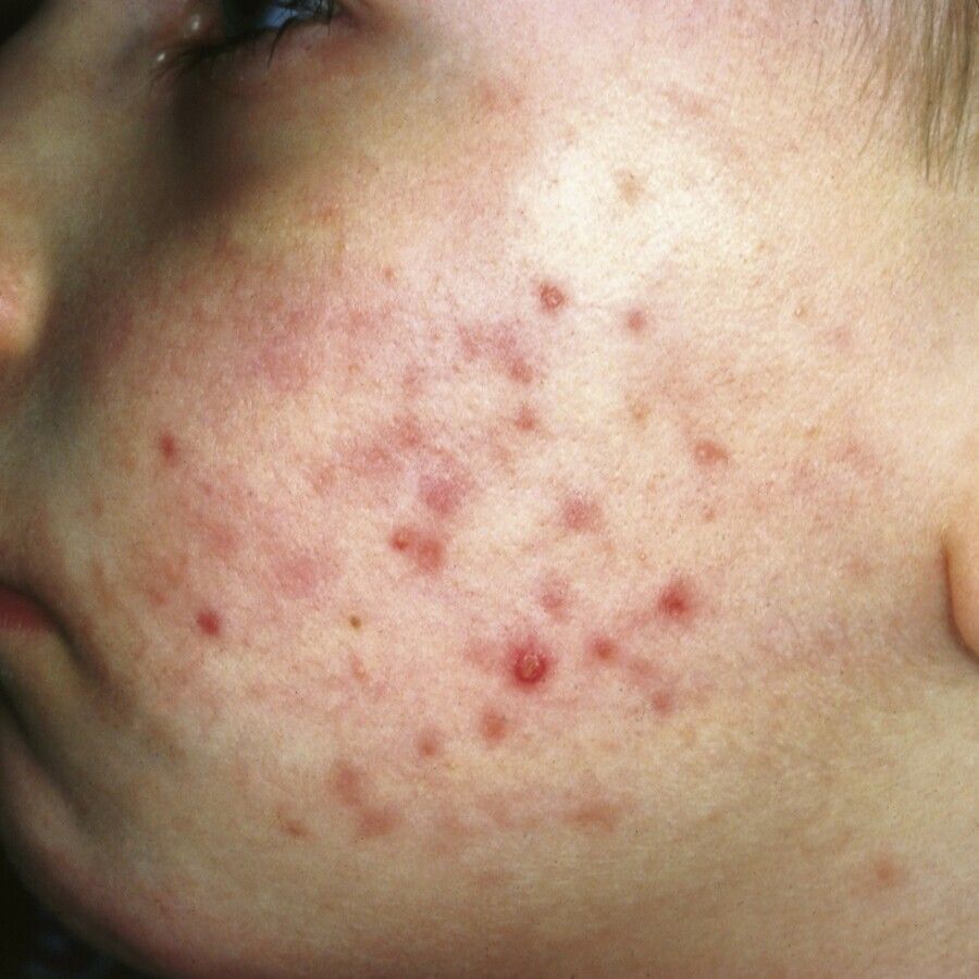 Acne Infantum