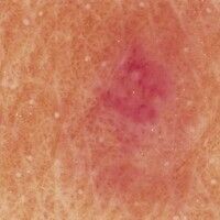 Mallorca acne Bilder - Altmeyers Enzyklopädie - Fachbereich Dermatologie