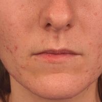 Acne papulopustulosa Images - Altmeyers Encyclopedia - Department ...