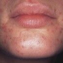 Oil acne - Altmeyers Encyclopedia - Department Dermatology