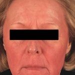 Airborne contact dermatitis - Altmeyers Encyclopedia - Department ...