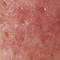 Acne comedonica Bilder - Altmeyers Enzyklopädie - Fachbereich Dermatologie