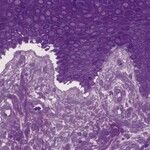 Epidermolysis bullosa simplex generalized intermediaries (köbner ...