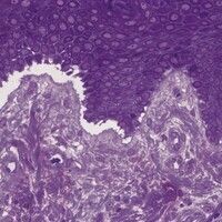 Epidermolysis bullosa simplex generalisierte intermediäre (Köbner ...