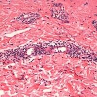 Erythema anulare centrifugum Bilder - Altmeyers Enzyklopädie ...