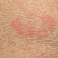 Erythema anulare centrifugum Bilder - Altmeyers Enzyklopädie ...