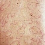 Erythema anulare centrifugum - Altmeyers Enzyklopädie - Fachbereich ...