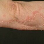 Erythema anulare centrifugum - Altmeyers Enzyklopädie - Fachbereich ...