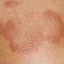 Neoprene allergy - Altmeyers Encyclopedia - Department Allergology