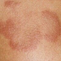 Erythema anulare rheumaticum Bilder - Altmeyers Enzyklopädie ...