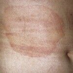 Erythema migrans - Altmeyers Encyclopedia - Department Dermatology