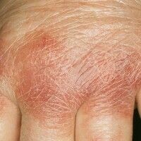 Erythema elevatum diutinum Bilder - Altmeyers Enzyklopädie ...