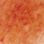 Erythema dyschromicum perstans - Altmeyers Enzyklopädie - Fachbereich ...