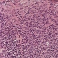 Erythroplasie Queyrat Bilder - Altmeyers Enzyklopädie - Fachbereich ...