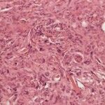 Fibroxanthom atypisches - Altmeyers Enzyklopädie - Fachbereich Dermatologie