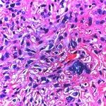 Fibroxanthom atypisches - Altmeyers Enzyklopädie - Fachbereich Dermatologie