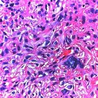 Fibroxanthom atypisches Bilder - Altmeyers Enzyklopädie - Fachbereich ...