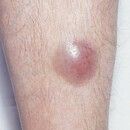 Micro abscesses - Altmeyers Encyclopedia - Department Dermatology