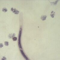 Filariose Bilder - Altmeyers Enzyklopädie - Fachbereich Dermatologie