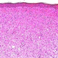 Fibroxanthom atypisches Bilder - Altmeyers Enzyklopädie - Fachbereich ...
